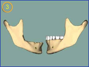 Consequences of Missing All Teeth - Advanced Periodontics & Implant ...