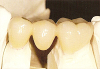 Single Tooth Bridge in NYC: One Tooth Single Tooth Bridge Cost