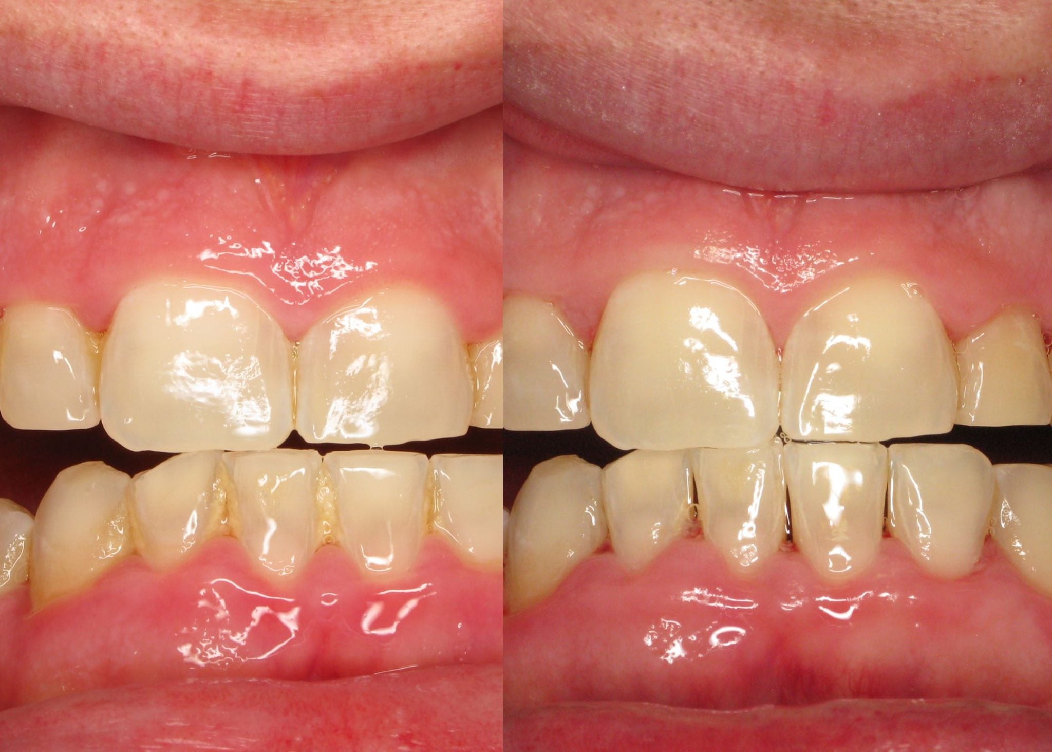 LANAP Used to Deep Clean Periodontal Disease - Advanced Periodontics ...