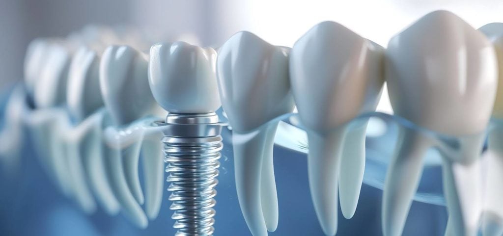 Dental Implants and MRI: Understanding Compatibility and Safety