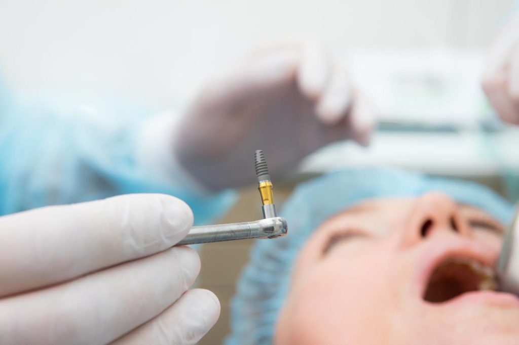 Understanding the Process: Removing Dental Implants Safely - Advanced ...